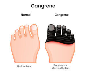 Gangrene Treatment in Downtown Brooklyn