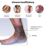 What Causes Dark Spots on Your Legs and How Treat Them?