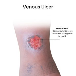 Venous Ulcers Treatment in Brooklyn, New York - Arterial Ulcers Specialist